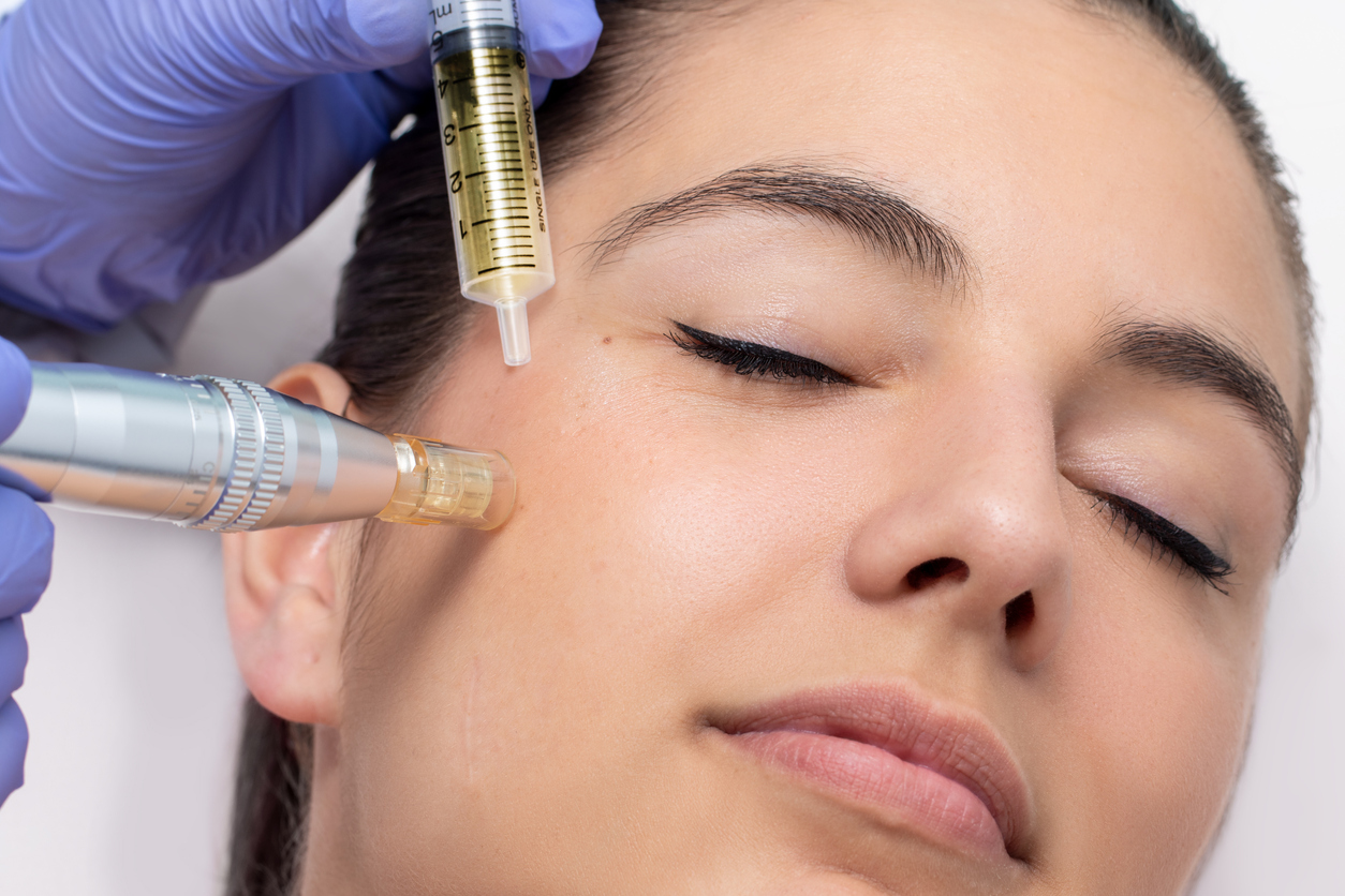 Microneedling with Tranexamic Acid | Torrey Pines Dermatology Microneedling with Tranexamic Acid | Torrey Pines Dermatology