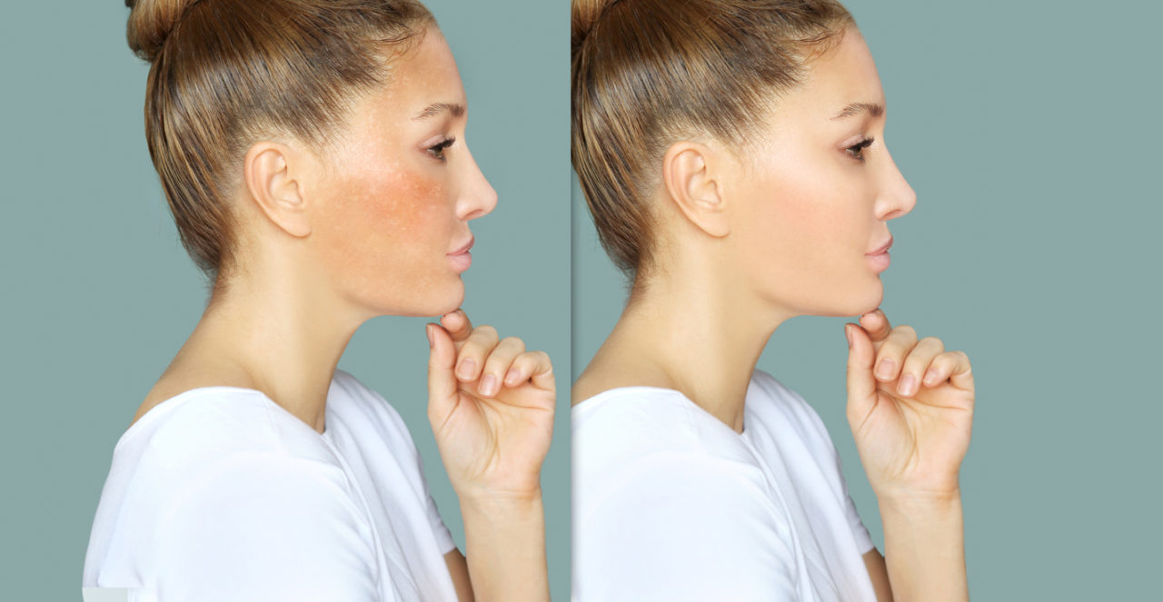Cosmetic Laser Treatments in La Jolla | Torrey Pines Dermatology