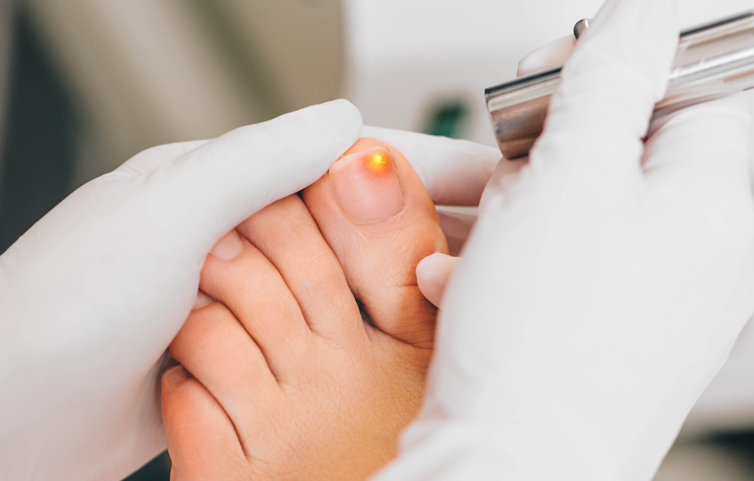 Cutera Toenail Fungus Treatment | Torrey Pines Dermatology