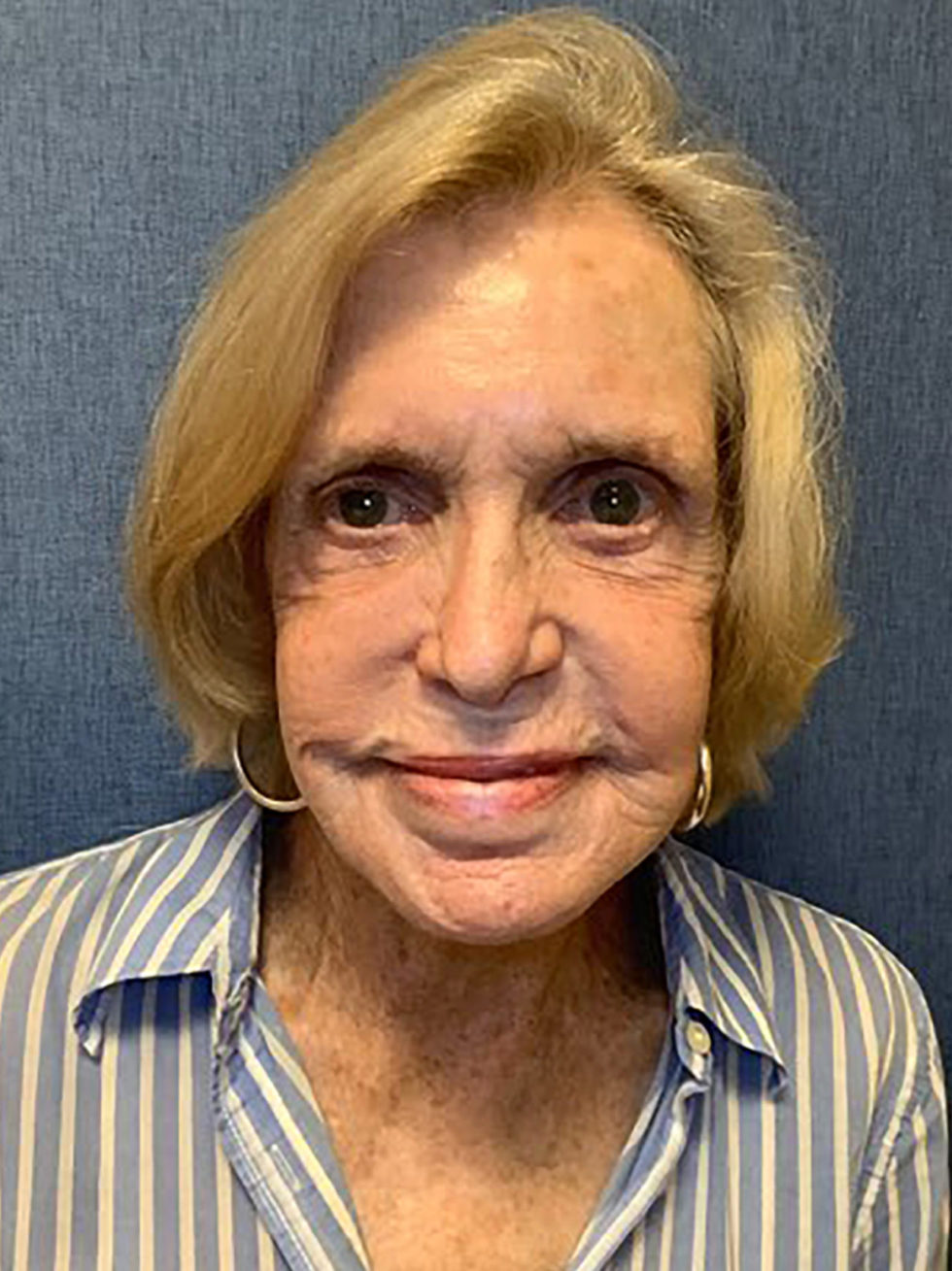 TotalFX Fractional CO2 Laser Resurfacing | Torrey Pines Dermatology